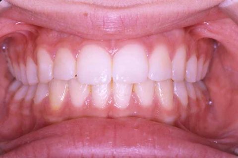 Biprotrusión - Tratamiento de Olga en Madrid y Albacete