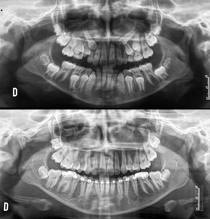Qu Son Los Dientes Incluidos GLOBALORTHODONTICS Qu Son Los Dientes Incluidos GLOBALORTHODONTICS
