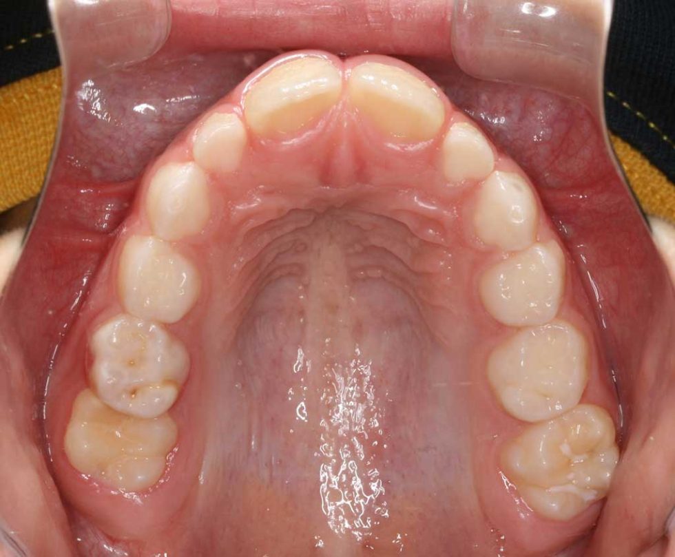 ¿Qué Hacer en un Niño Cuando las Muelas Superiores de los 6 Años No ...