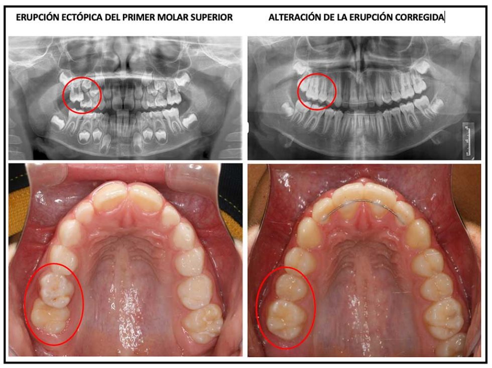 ¿Qué Hacer en un Niño Cuando las Muelas Superiores de los 6 Años No ...